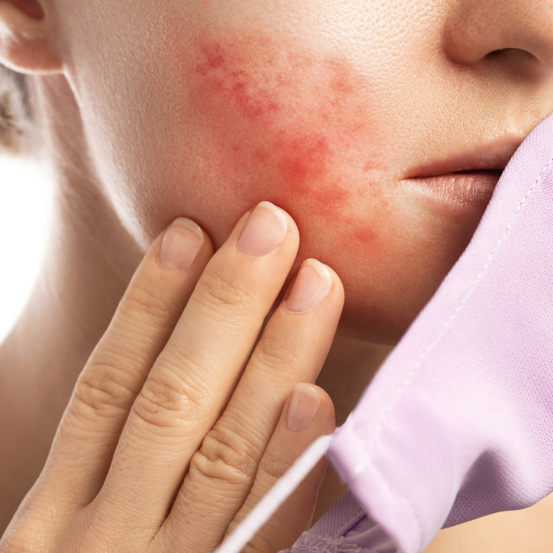 Akné a nejmodernější metody terapie